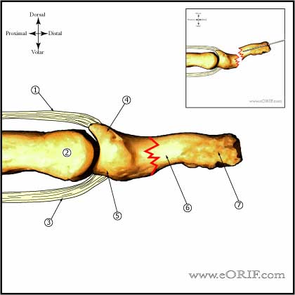 Distal Phalanx Fracture Classification | eORIF