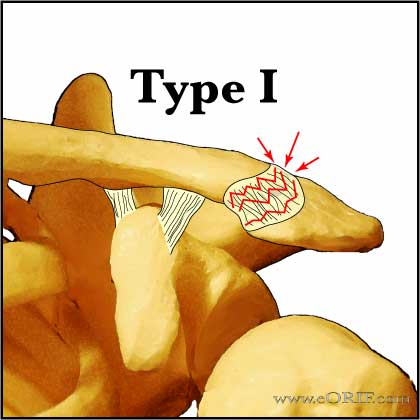 Acromioclavicular Joint Separation Classification | eORIF