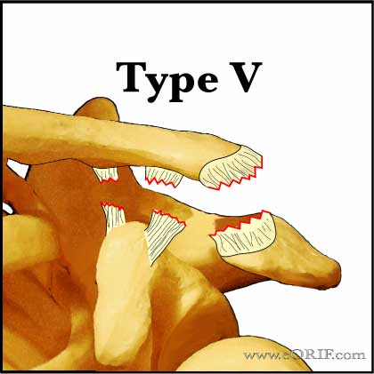 Acromioclavicular Joint Separation Classification | eORIF