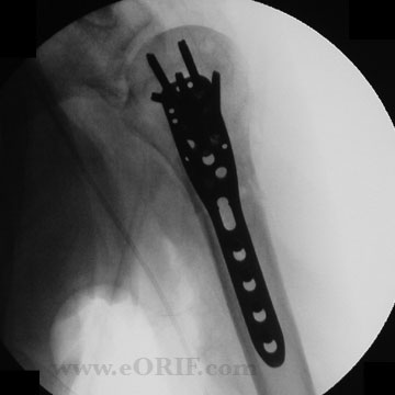 Proximal Humerus Fracture ORIF Cases | eORIF